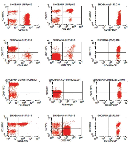 | Figure 1 The cells showed positivity for CD3, CD4, CD5, CD2, CD16, CD56, and - CD57 ...